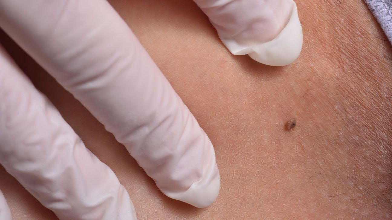 The Role of Skin Tags in Skin Health: When Removal is Necessary - DGM News